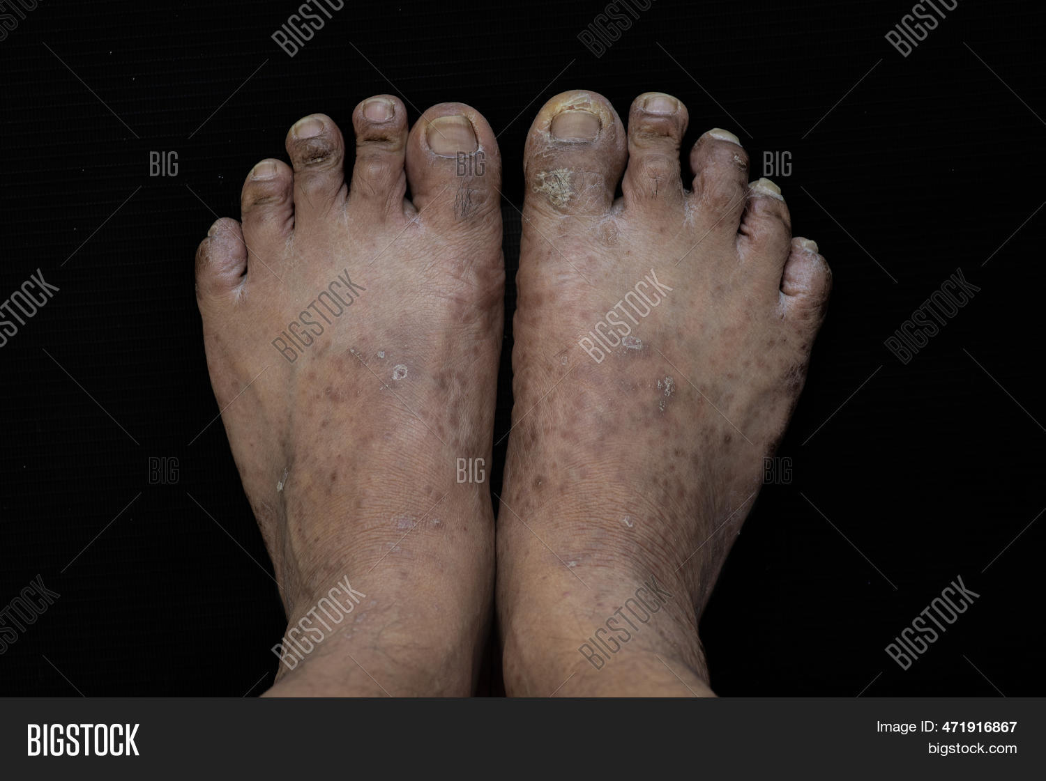 Chemical Dermatitis Image & Photo (Free Trial) | Bigstock