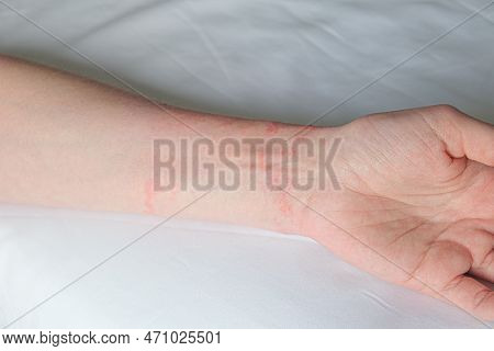 Jellyfish Bite Marks Image & Photo (Free Trial) | Bigstock
