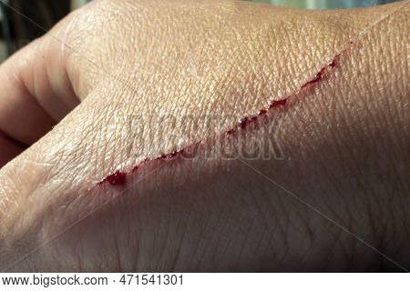 Injured Scratched Image & Photo (Free Trial) | Bigstock