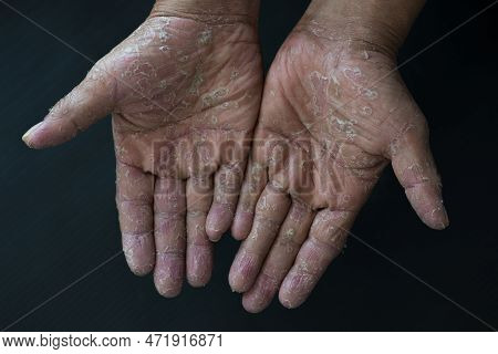 Chemical Dermatitis Image & Photo (Free Trial) | Bigstock