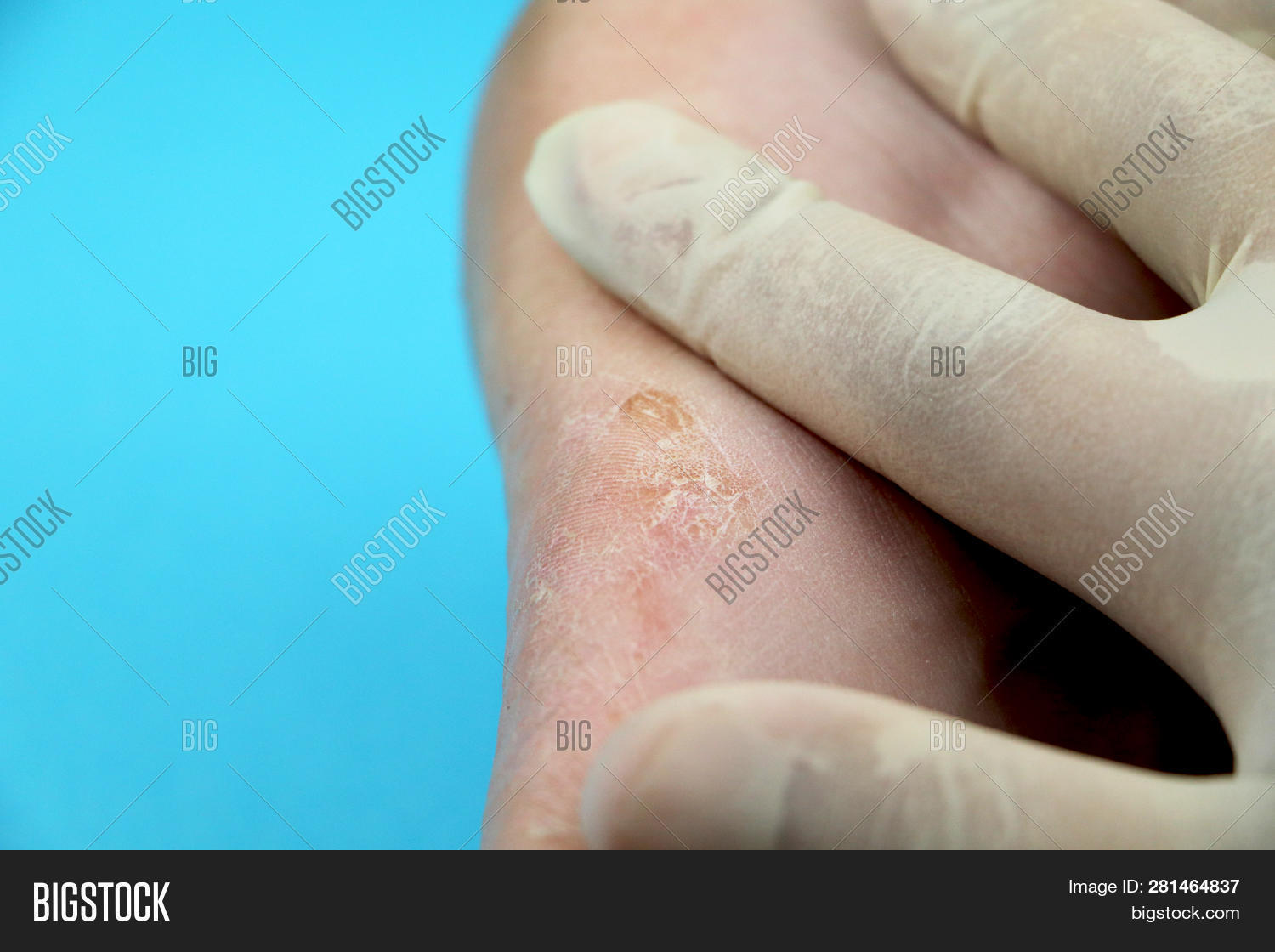Fungus Foot Close-, Image & Photo (Free Trial) | Bigstock
