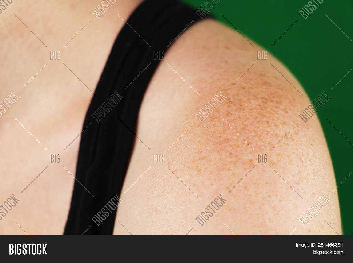 Freckles On Back Man Image & Photo (Free Trial) | Bigstock