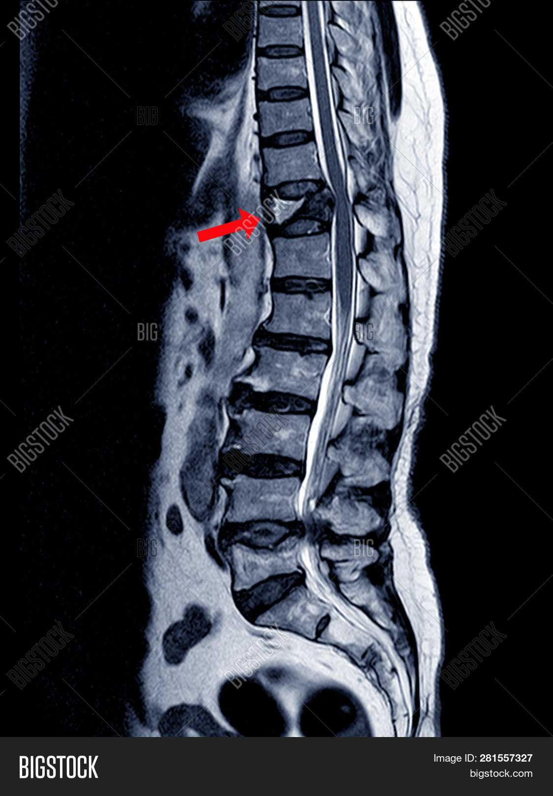 Mri Thoracic Lumbar Image & Photo (Free Trial) | Bigstock