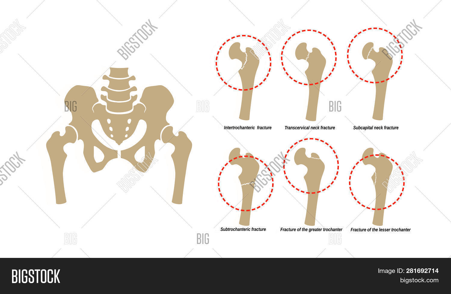 6 Types Femoral Neck Image & Photo (Free Trial) | Bigstock