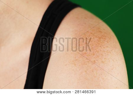 Freckles On Back Man Image & Photo (Free Trial) | Bigstock