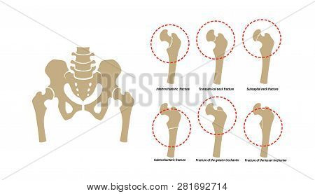 6 Types Femoral Neck Image & Photo (Free Trial) | Bigstock