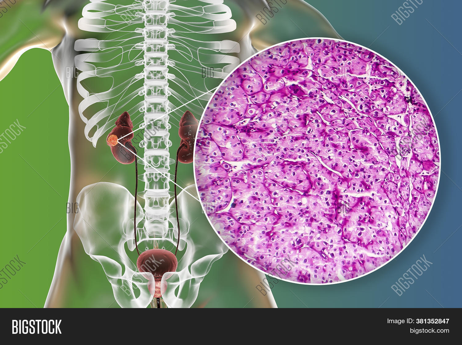 Kidney Cancer, Renal Image & Photo (Free Trial) | Bigstock