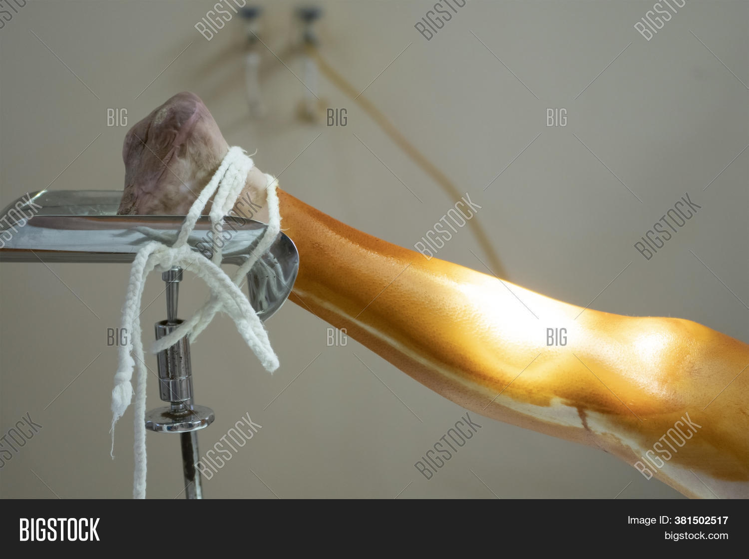 Diseased Leg Fixed Image & Photo (Free Trial) | Bigstock