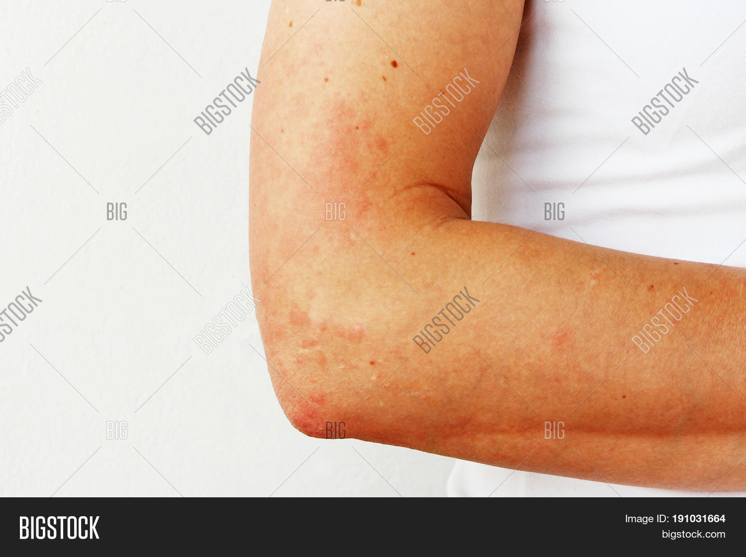 Red Pustules Vesicles Image & Photo (Free Trial) | Bigstock