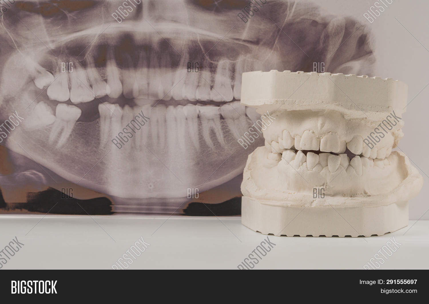 Dental Casting Gypsum Image & Photo (Free Trial) | Bigstock