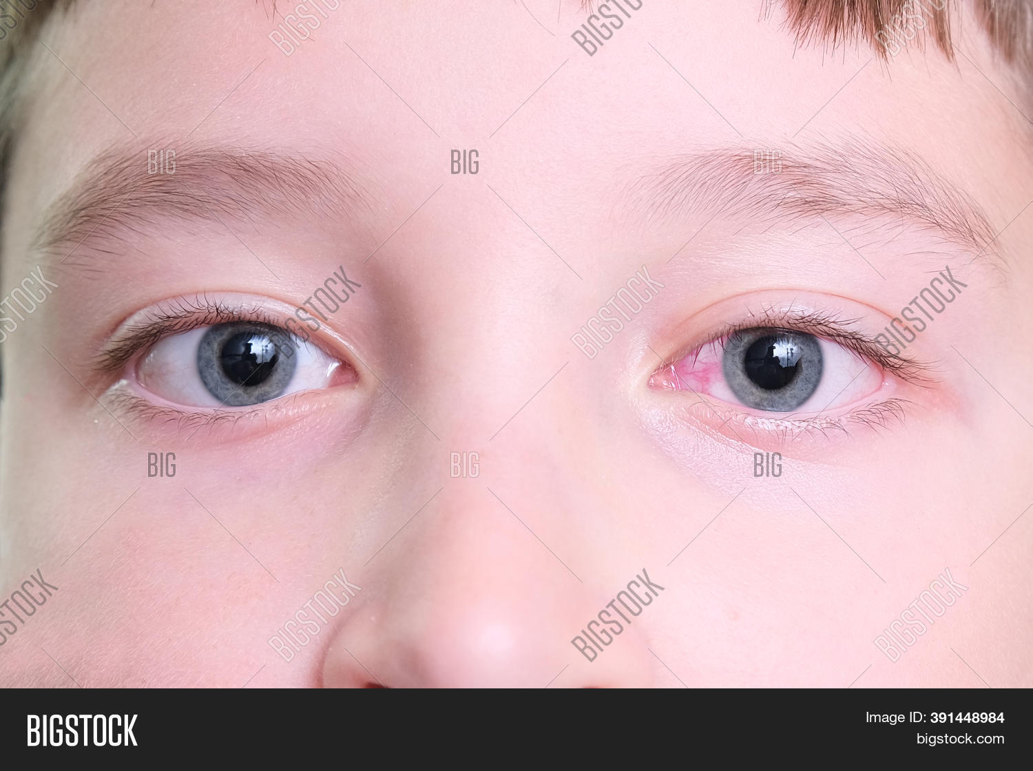Boy Red Irritated Eye Image & Photo (Free Trial) | Bigstock