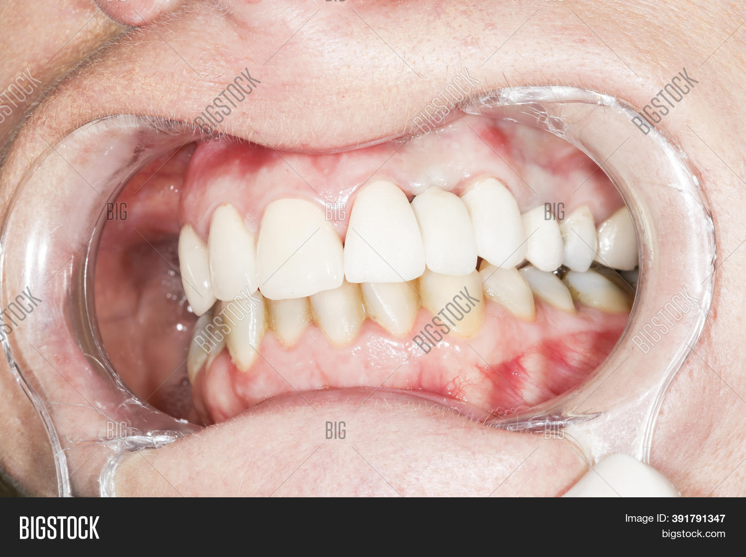 Woman Teeth Before Image & Photo (Free Trial) | Bigstock