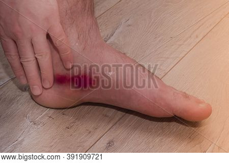 Injury, Contusion, Image & Photo (Free Trial) | Bigstock