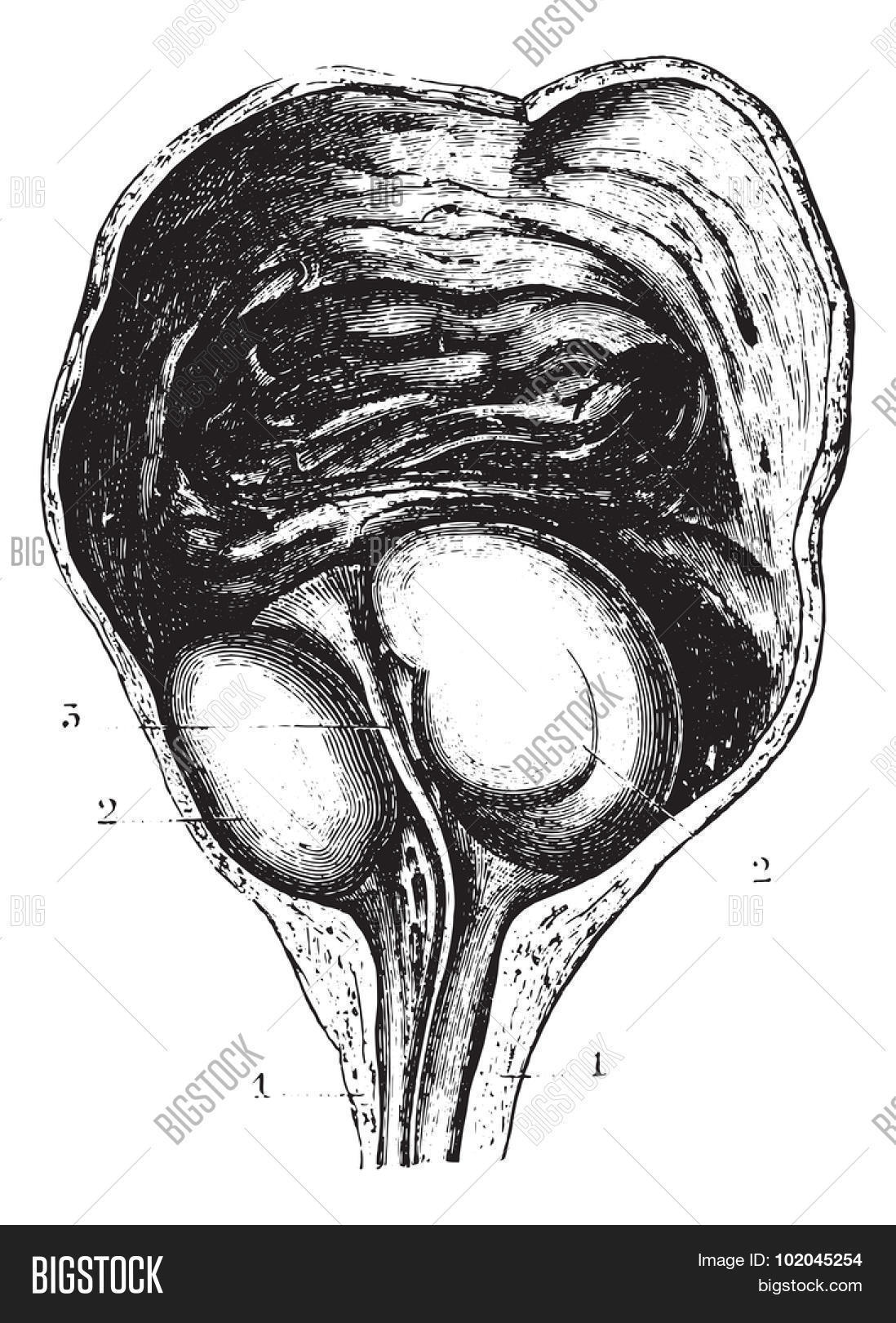 Vector y foto Enlarged Prostate (prueba gratis) | Bigstock