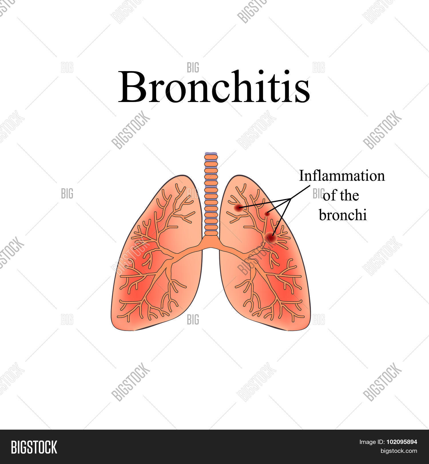 Bronchitis. Vector & Photo (Free Trial) | Bigstock