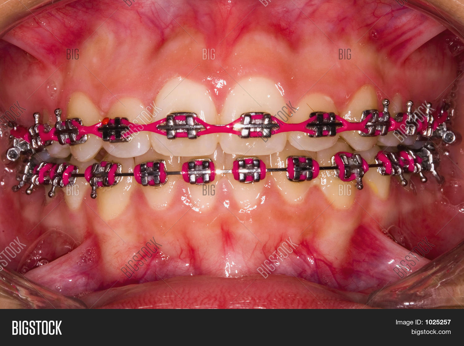 Orthdontic Braces Image & Photo (Free Trial) | Bigstock