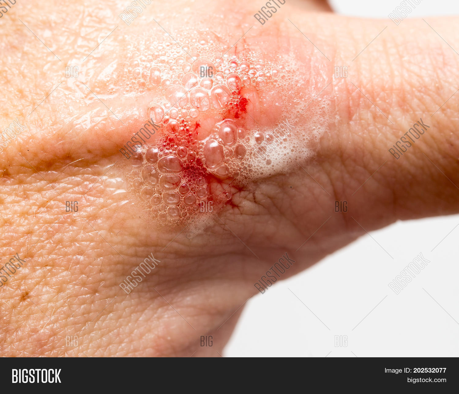 Blood On Skin Cut Image & Photo (Free Trial) | Bigstock