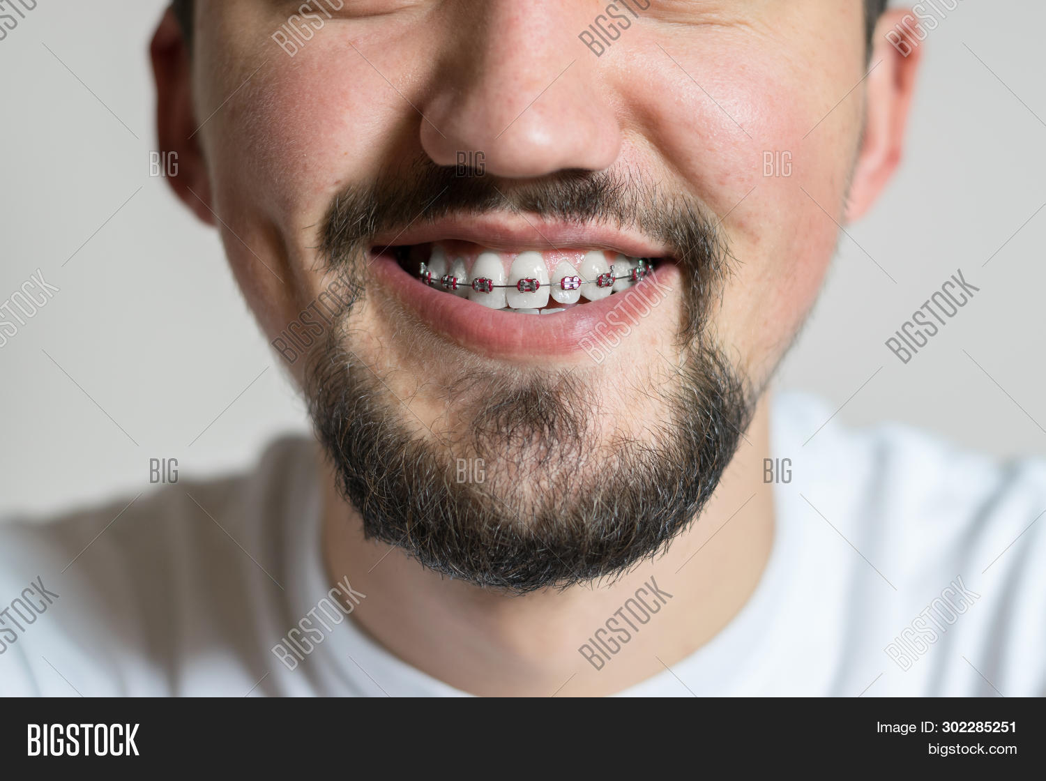 Close Young Man Braces Image & Photo (Free Trial) | Bigstock