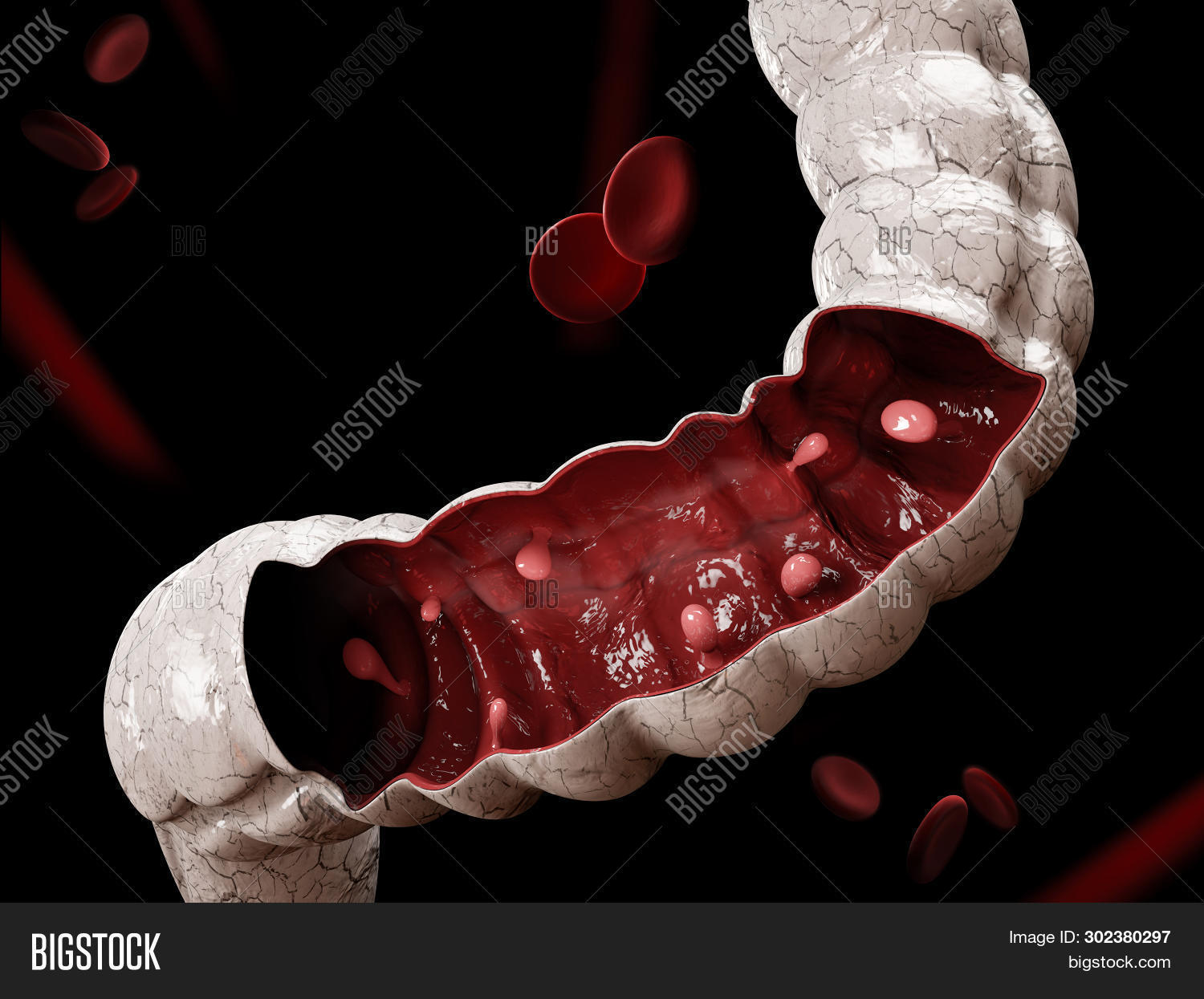 Imagen y foto Colon Polyps. 3d (prueba gratis) | Bigstock