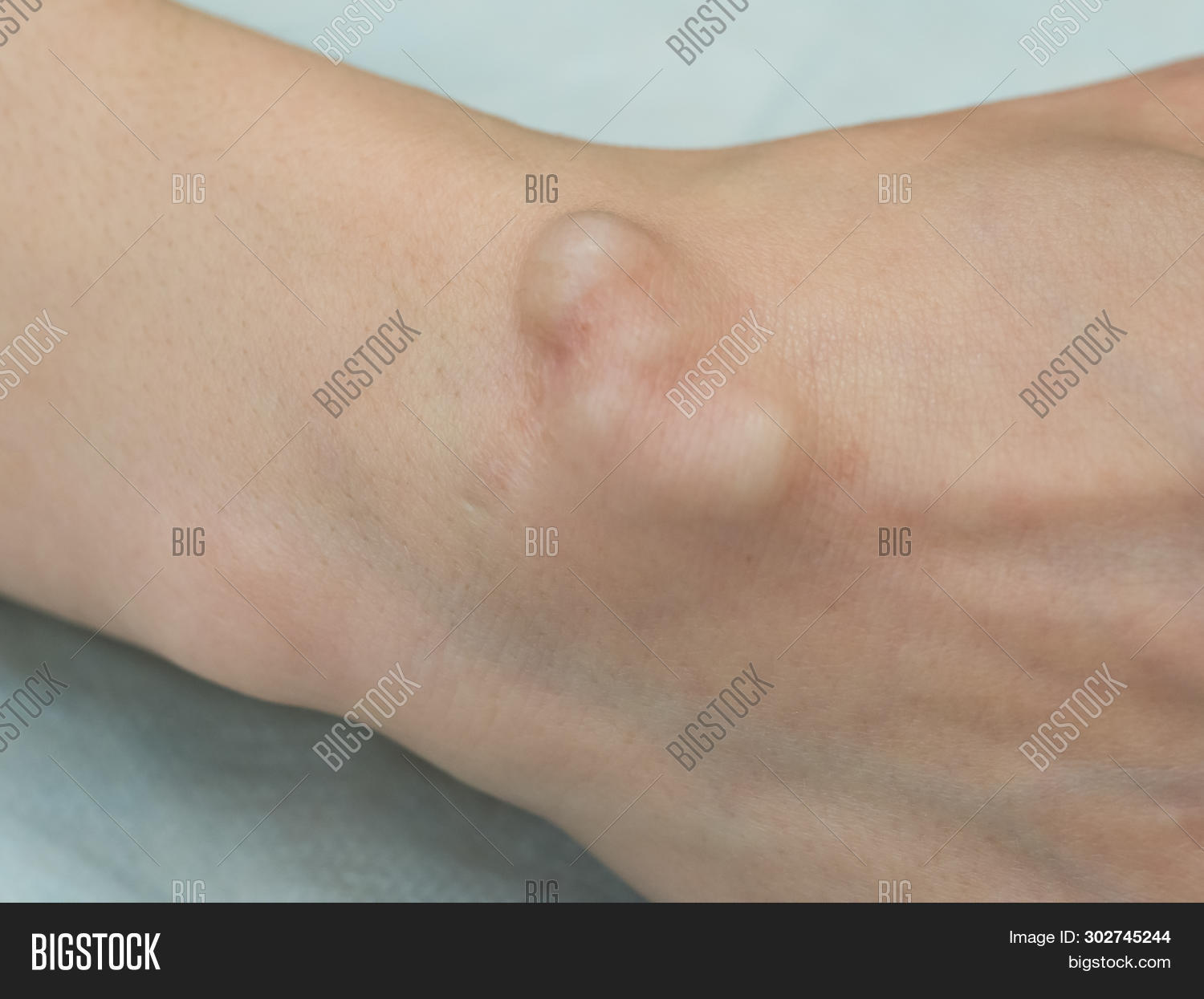 Big Cyst Hygroma, Image & Photo (Free Trial) | Bigstock