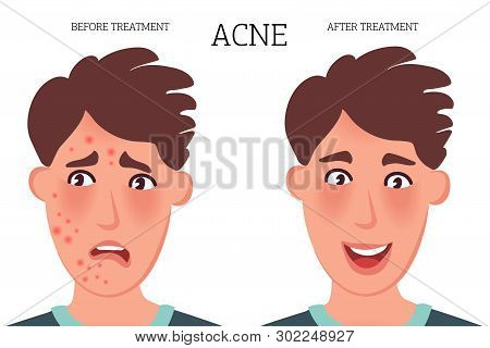 Face Person Acne Vector & Photo (Free Trial) | Bigstock