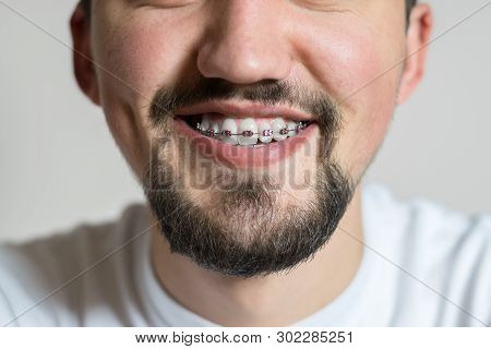 Close Young Man Braces Image & Photo (Free Trial) | Bigstock
