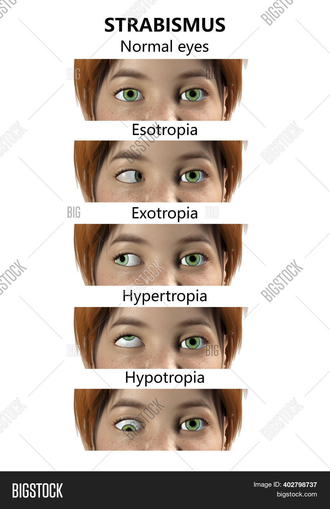 Strabismus Children, Image & Photo (Free Trial) | Bigstock