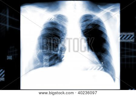 Male Chest X-ray On Image & Photo (Free Trial) | Bigstock