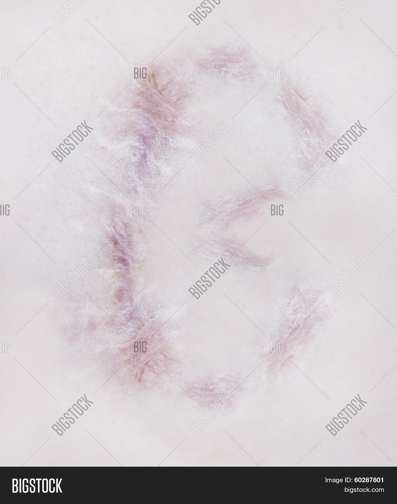 Scar Letter B On Human Image & Photo (Free Trial) | Bigstock