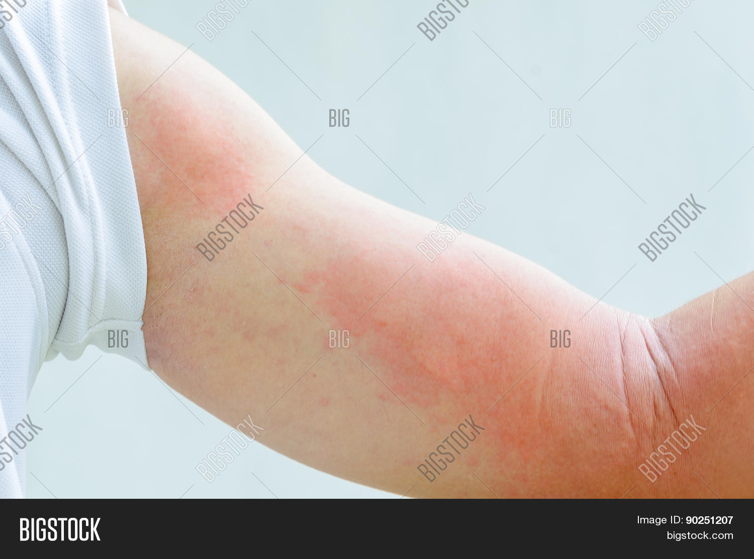 Urticaria Image & Photo (Free Trial) | Bigstock