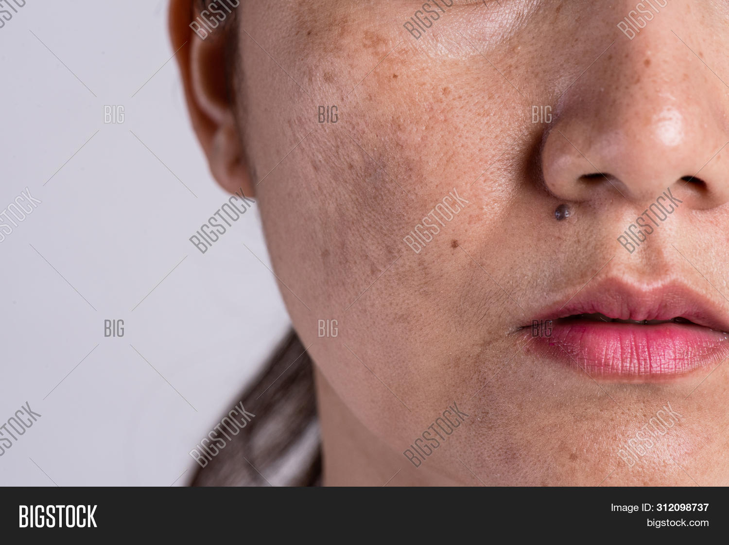 Woman Problematic Skin Image & Photo (Free Trial) | Bigstock