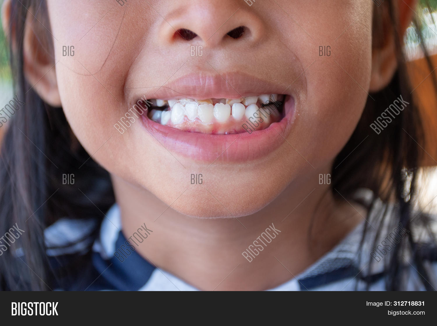Stacked Front Tooth, Image & Photo (Free Trial) | Bigstock