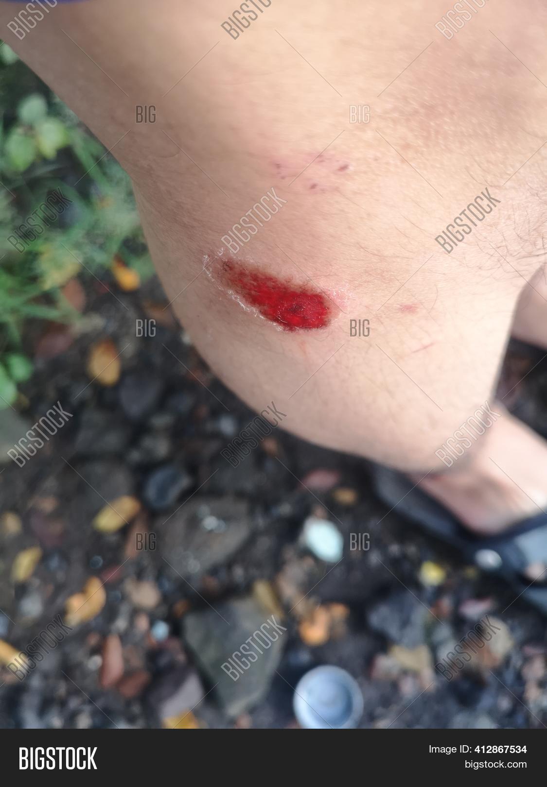 Scratches On Skin Image & Photo (Free Trial) | Bigstock