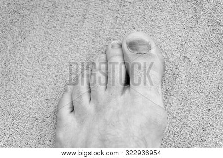 Injury Toe Nail. Image & Photo (Free Trial) | Bigstock