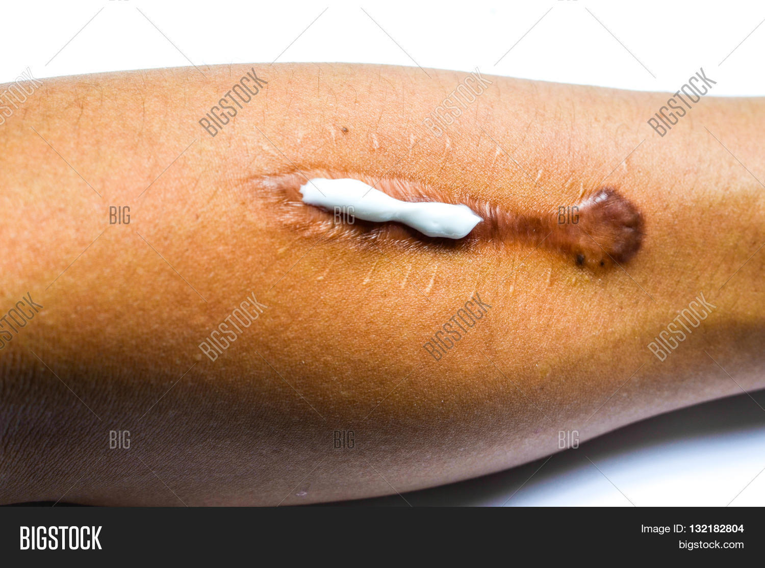 Treatment Scar On Man Image & Photo (Free Trial) | Bigstock