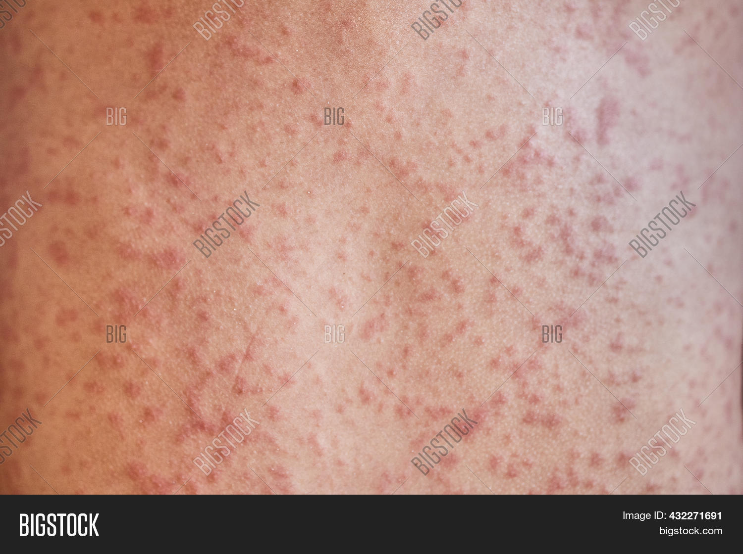 Allergic Rash On Body Image & Photo (Free Trial) | Bigstock