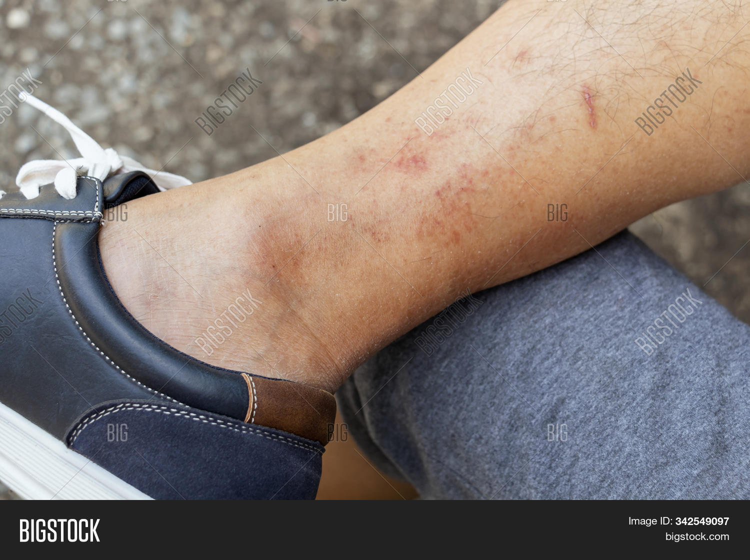 Skin Disease Winter. Image & Photo (Free Trial) | Bigstock