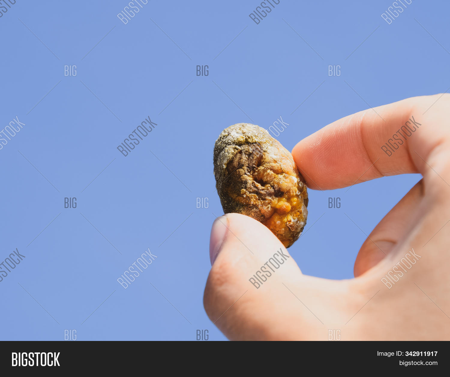 Stone Gallbladder. Image & Photo (Free Trial) | Bigstock