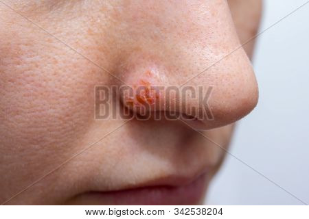 Herpes On Nose - Image & Photo (Free Trial) | Bigstock