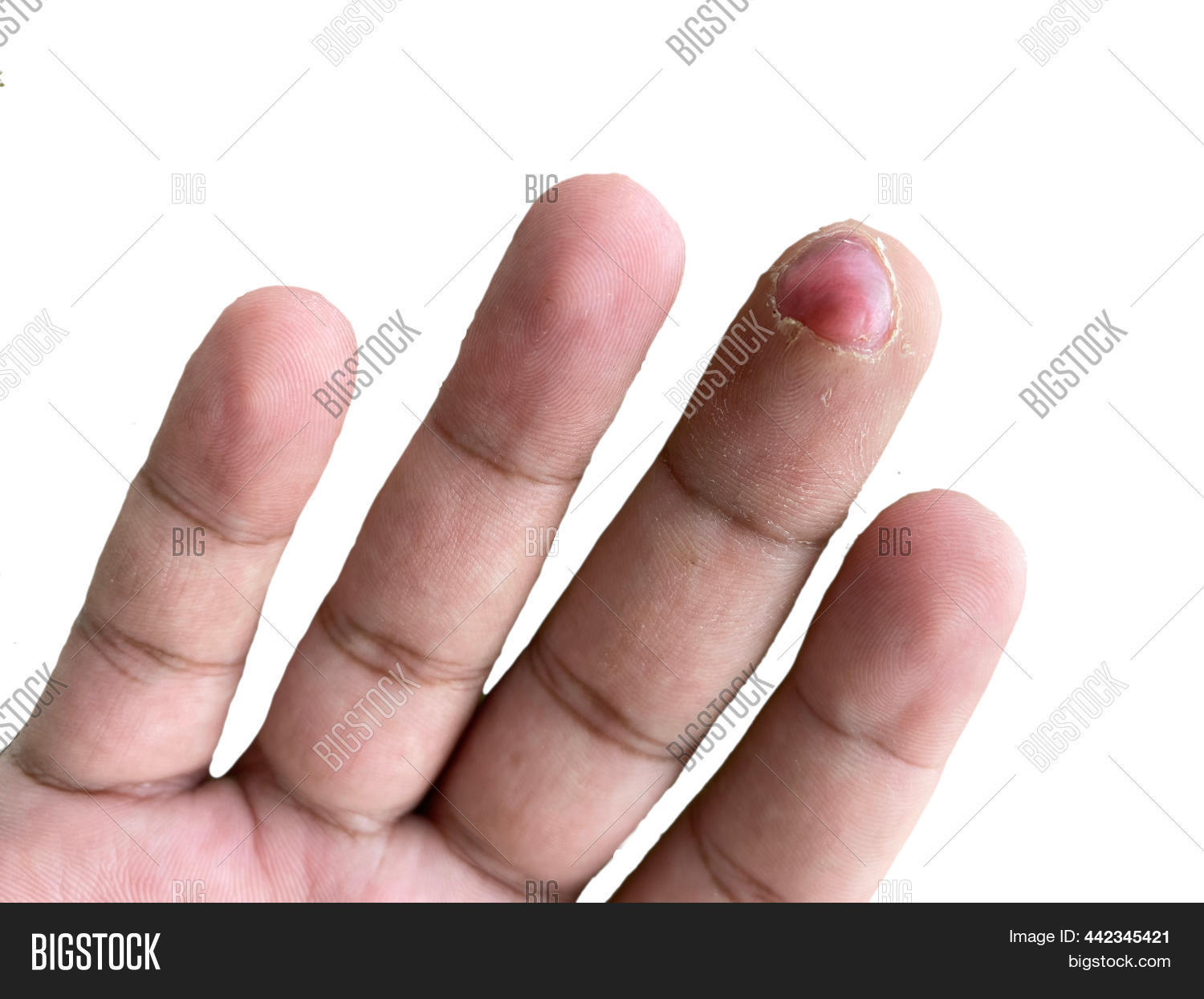 Scraped Peeled Finger Image & Photo (Free Trial) | Bigstock