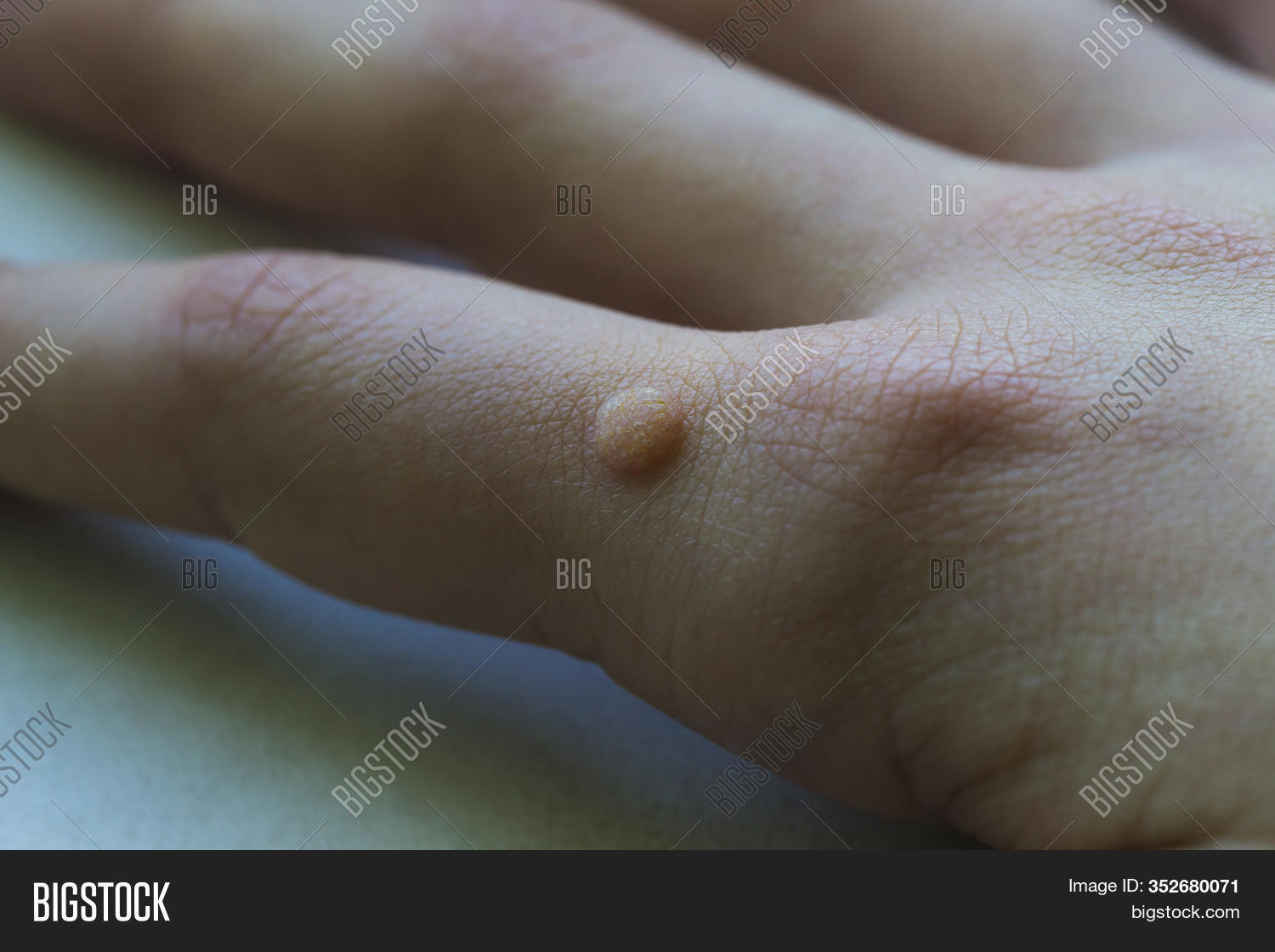 Common Wart Verruca Image & Photo (Free Trial) | Bigstock