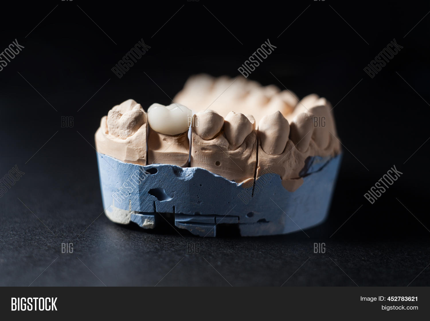 Mold Teeth. Gypsum Image & Photo (Free Trial) | Bigstock