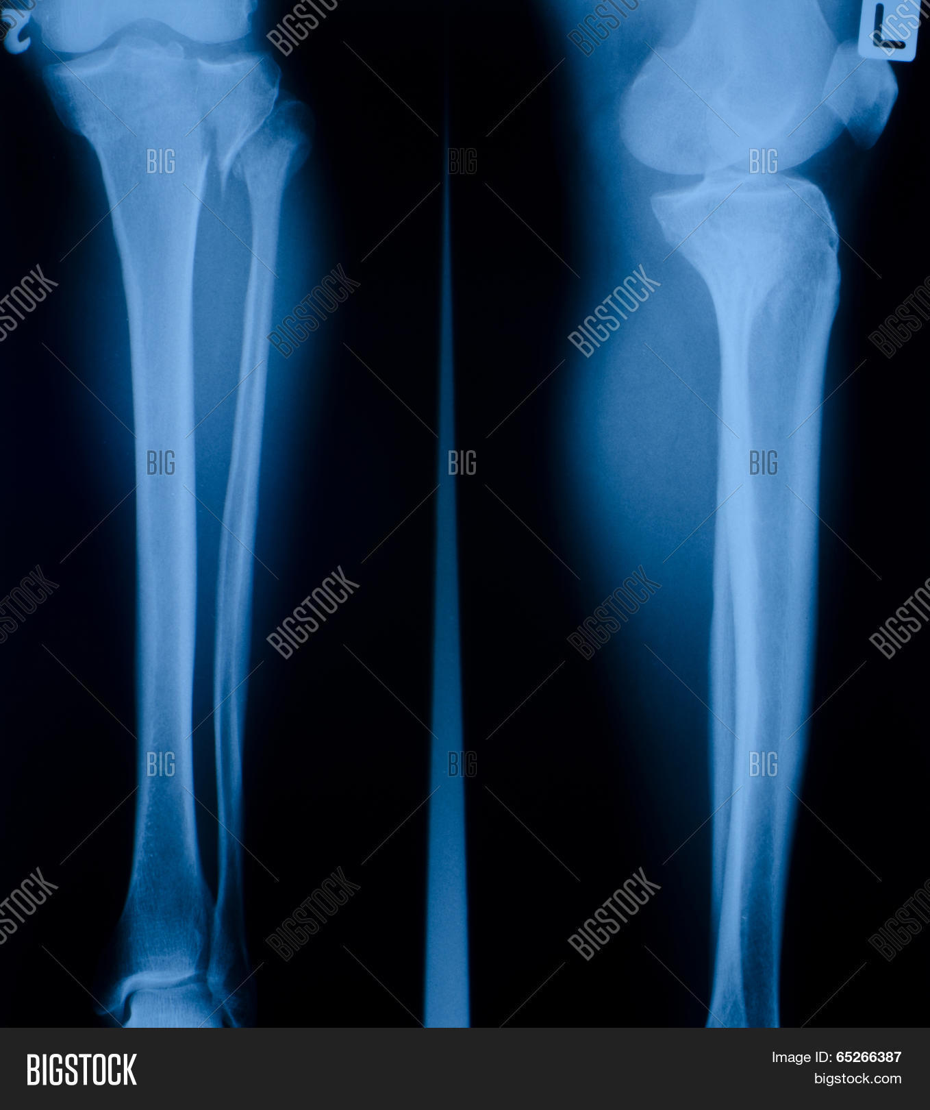 X-ray Film Proximal Image & Photo (Free Trial) | Bigstock