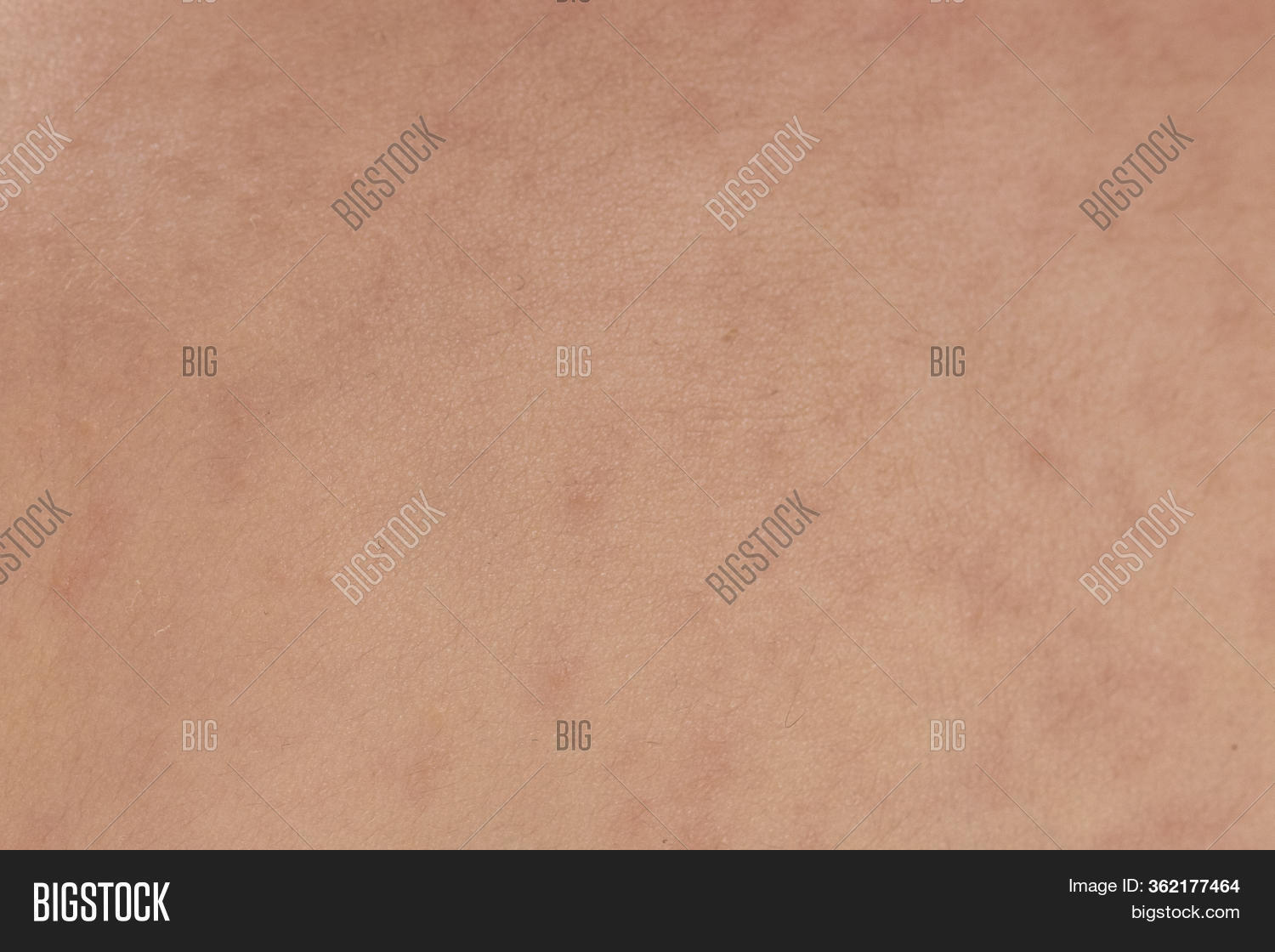 Roseola Rash Viral Image & Photo (Free Trial) | Bigstock