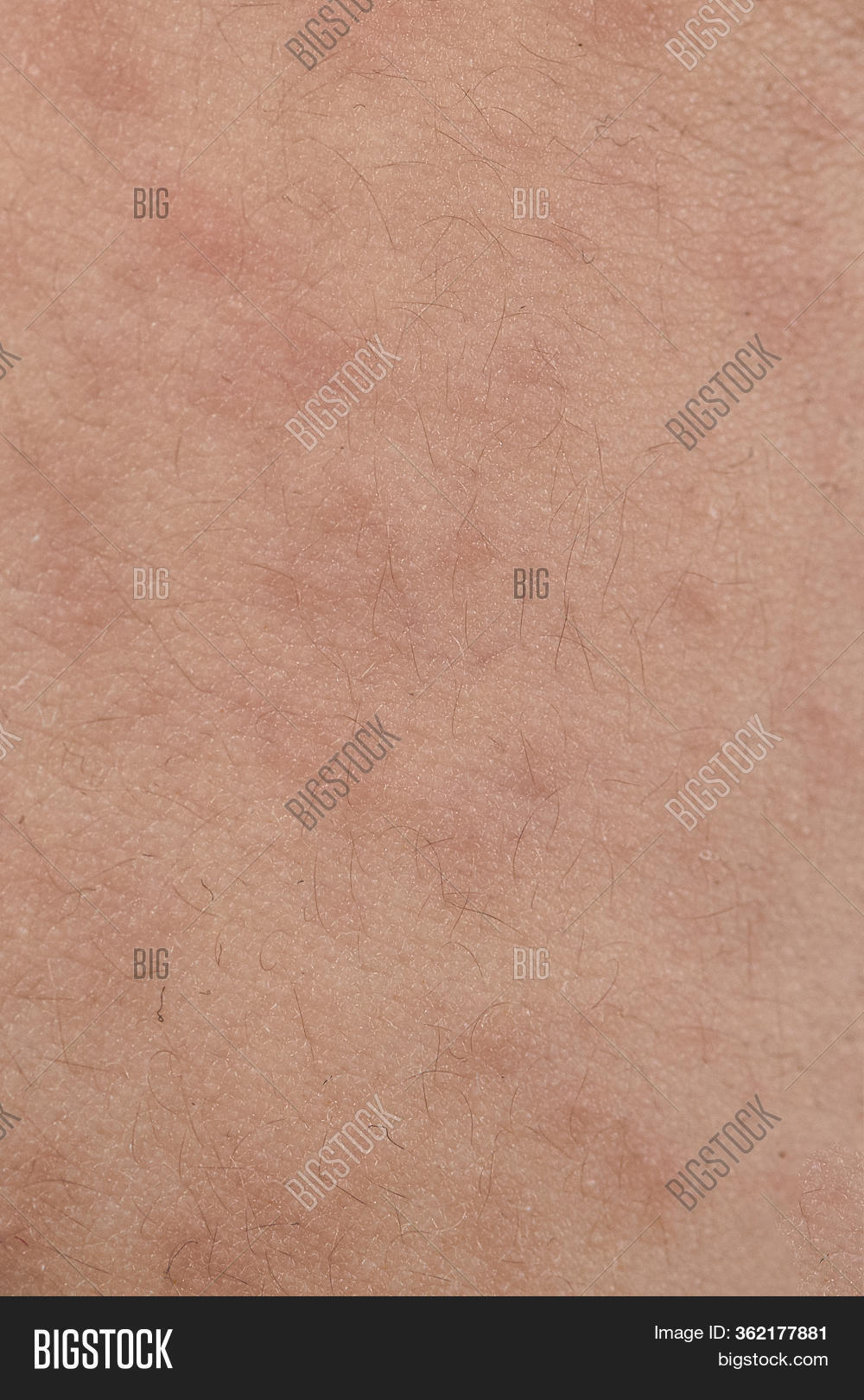 Roseola Rash Viral Image & Photo (Free Trial) | Bigstock