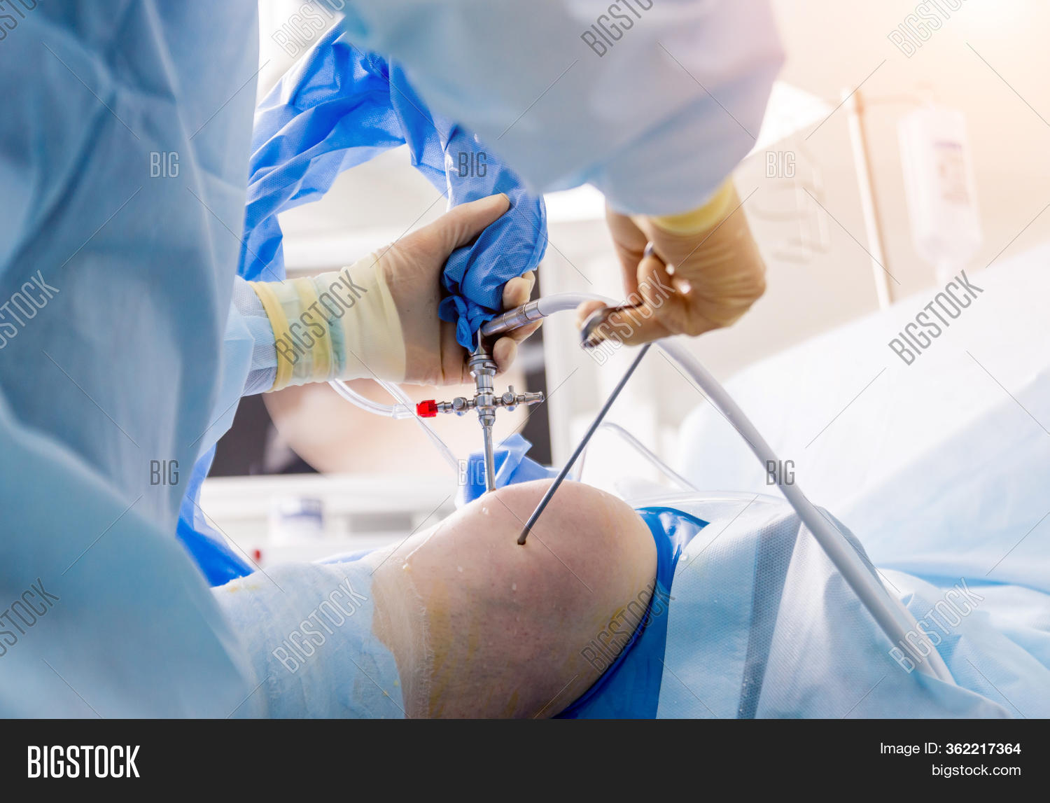Arthroscope Surgery. Image & Photo (Free Trial) | Bigstock