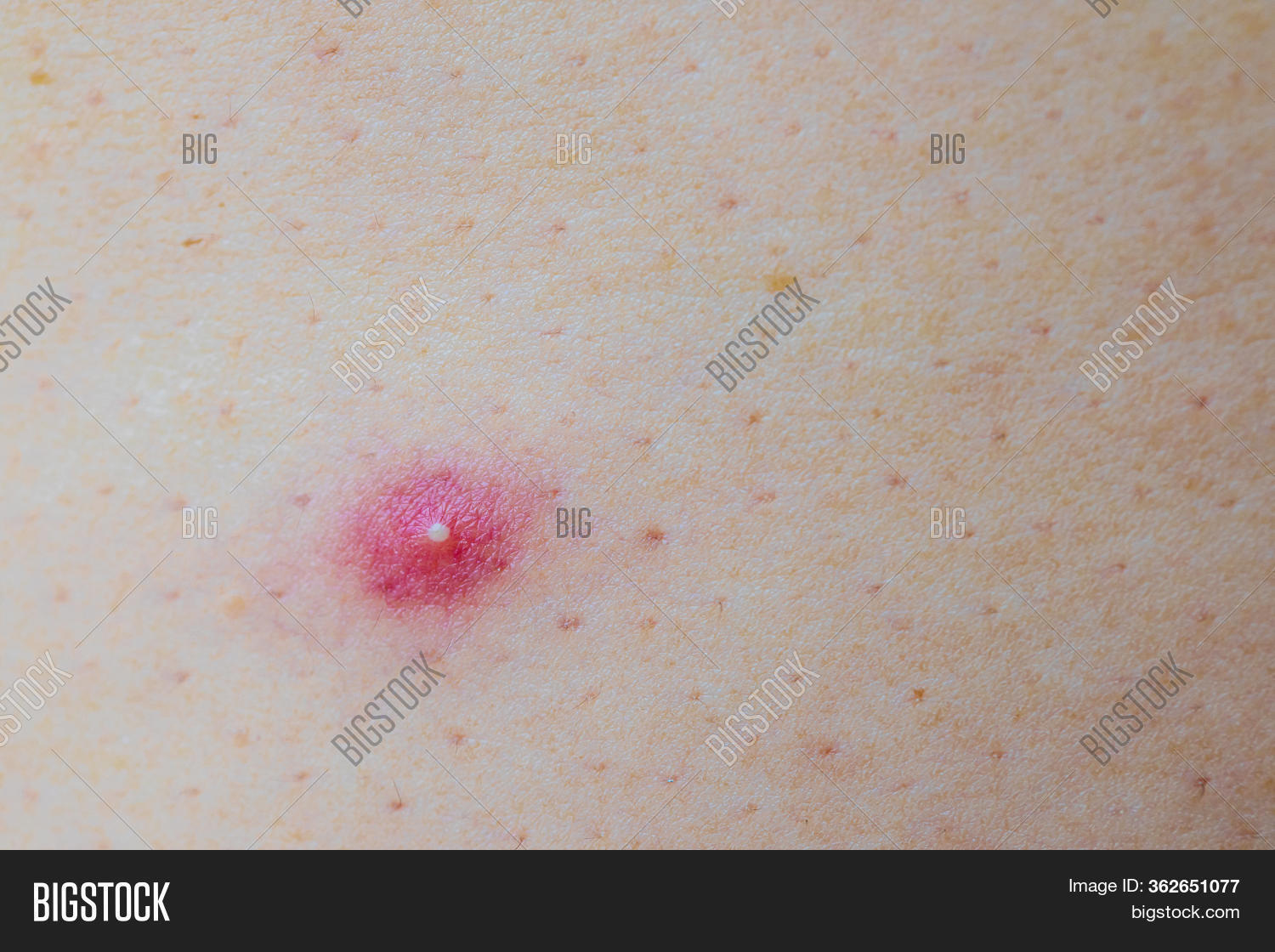 Close Photo Nodular Image & Photo (Free Trial) | Bigstock