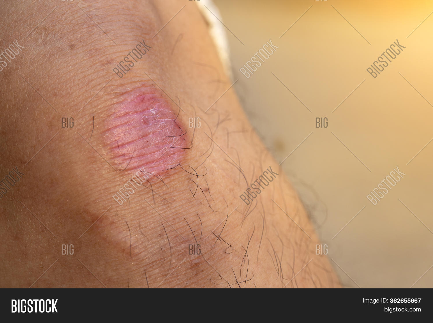 Ring Worm Infection, Image & Photo (Free Trial) | Bigstock