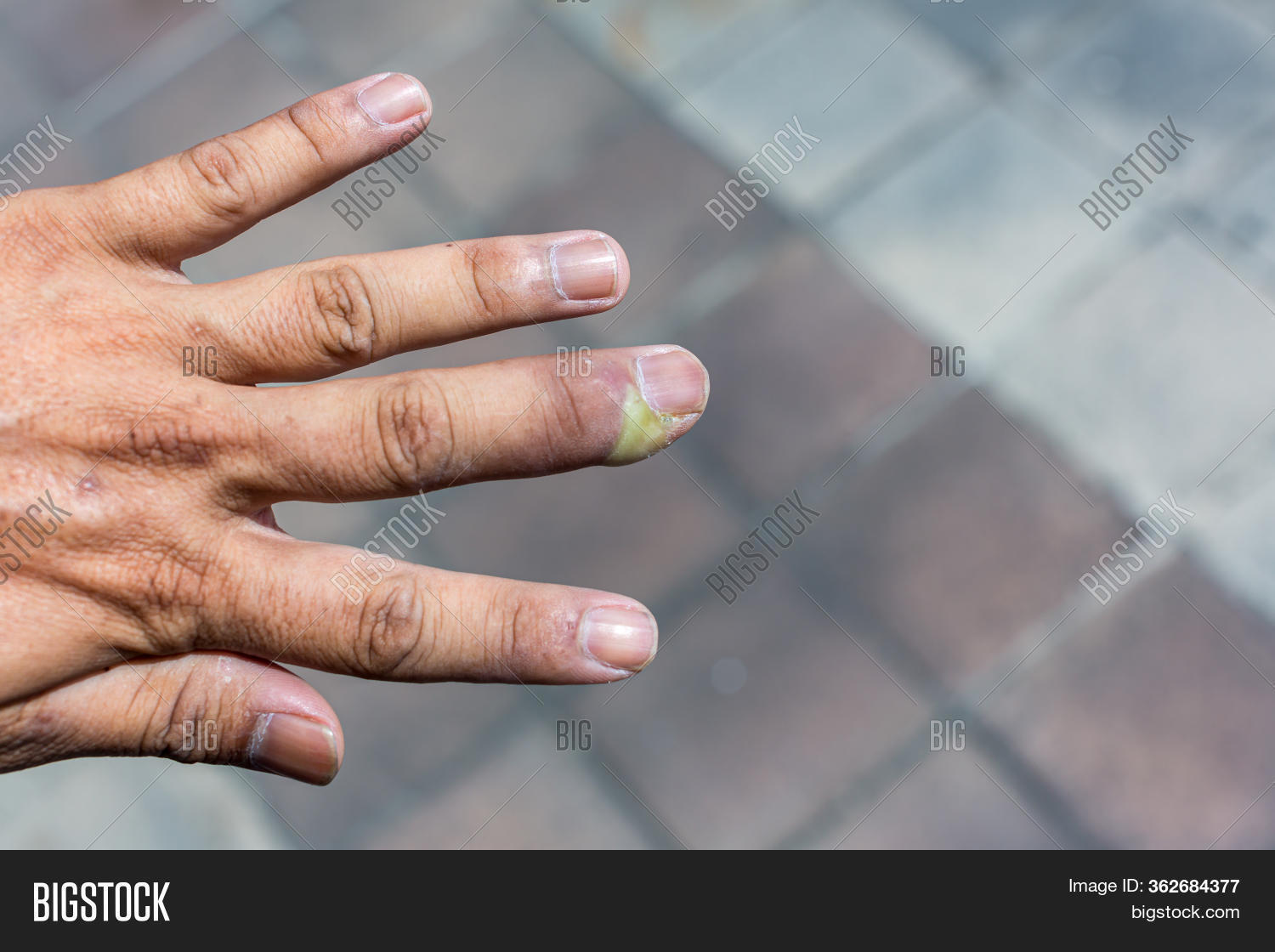 Paronychia, Swollen Image & Photo (Free Trial) | Bigstock