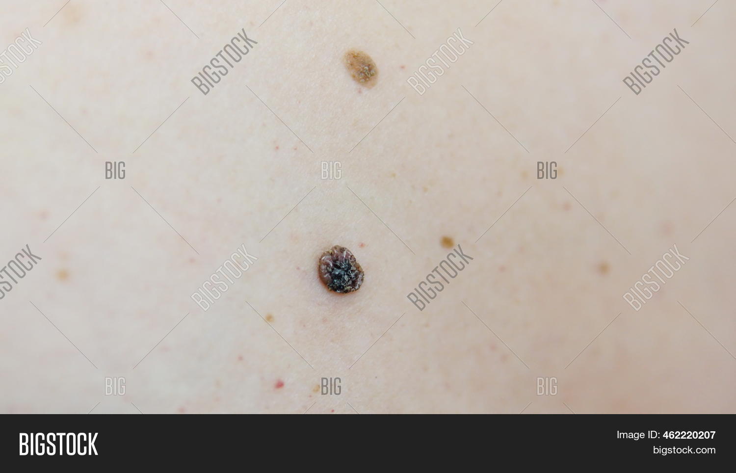 Red Moles Dots On Image & Photo (Free Trial) | Bigstock